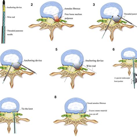 Intraoperative Visualization Of The Annulus Fibrosus Suture Process Download Scientific