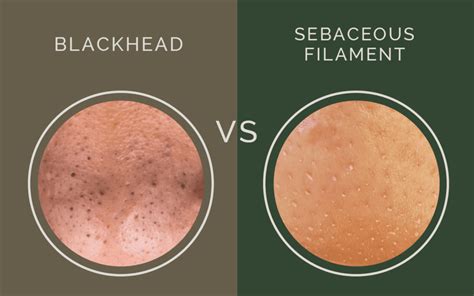 Are They Blackheads Or Something Else Like Sebaceous Filaments Grounded Sage