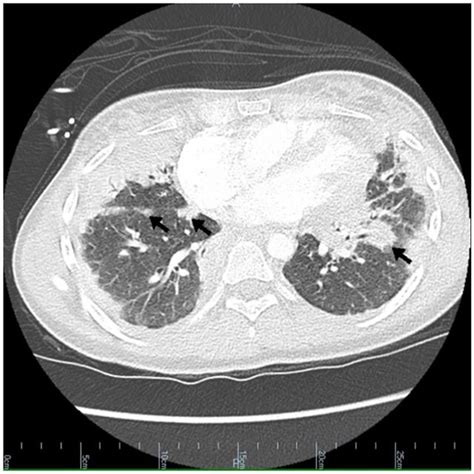 Hrct Of The Patient With Scattered Granuloma At Lung Bases Black Arrow