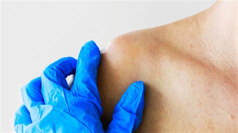 Comprehensive Guide To Clavicle Fracture Orif Orif Clavicle Understanding Surgery And