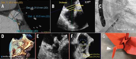 Three Dimensional Multiplanar Reconstruction By Transoesophageal