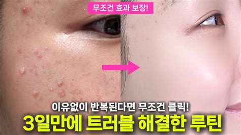 반복되는 여드름이 고민이라구요 홈케어 전문가가 알려주는 여드름 박멸 루틴 좁쌀여드름 관리법 피부관리법 Youtube