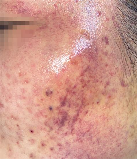 얼굴 핏줄터짐멍 지식in