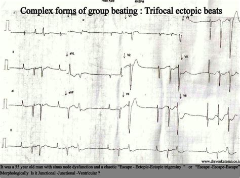Escape Ectopic Trigeminy An Unique Ecg Sign In Sinus Node Dysfunction Dr S Venkatesan Md