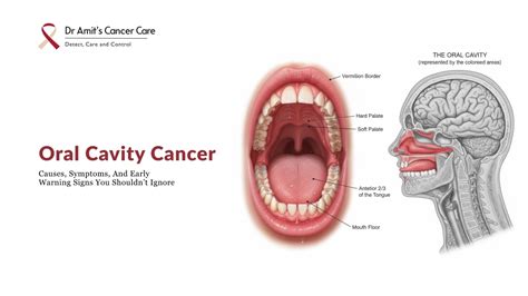 Oral Cavity Cancer Causes Symptoms Staging And Treatment