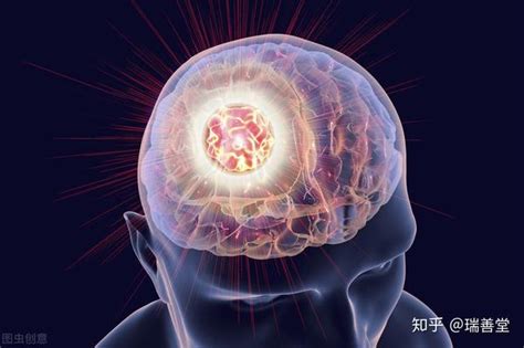 脑肿瘤的10大征兆，出现5个以上，赶快去医院！ 知乎