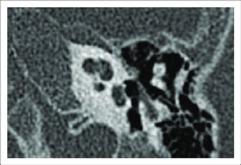 Stenosis Of The Bony Cochlear Nerve Canal Cnc In This Patient The