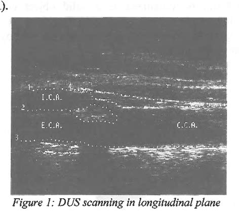 Figure 1 From 3 D Carotid Artery Reconstruction From Dus Images Semantic Scholar