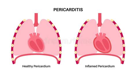 Pericarditis Hartziekte Vector Illustratie Illustration Of Spier 281243448