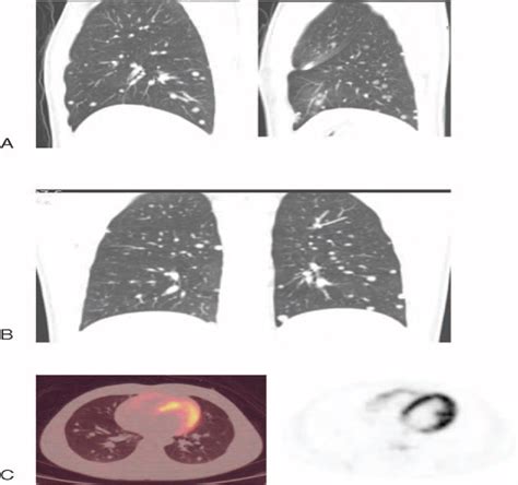 Primary Multiple Pulmonary Primitive Neuroectodermal Tumor Medicine