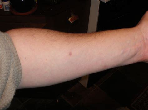 What Does A Negative Skin Tb Test Look Like At Shawn Cummings Blog