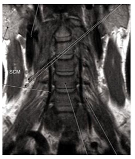 Abel Where Is The Following Parotid Gland Vertebral Artery Odontoid Process 3rd Cervical