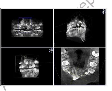 Orthopantomographic Image Of A Girl With Impacted Central Maxillary