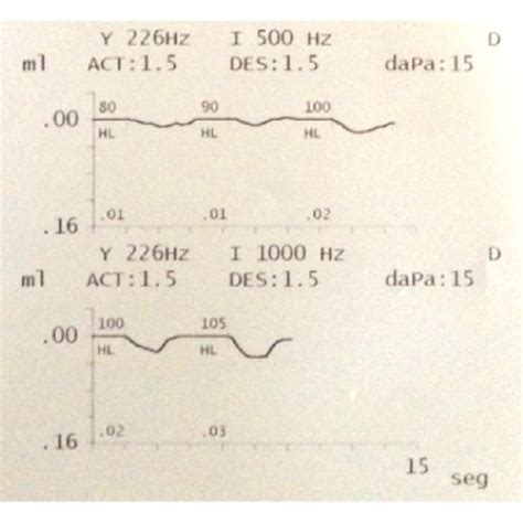 A Right Ear Tympanogram Was Consistent With A Type A Curve B Download Scientific Diagram