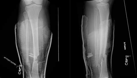 Right Tibia