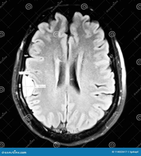 Brain Extra Axial Convexity Mass Lesion Mri Exam Stock Image Image Of Human Anatomy 114022617