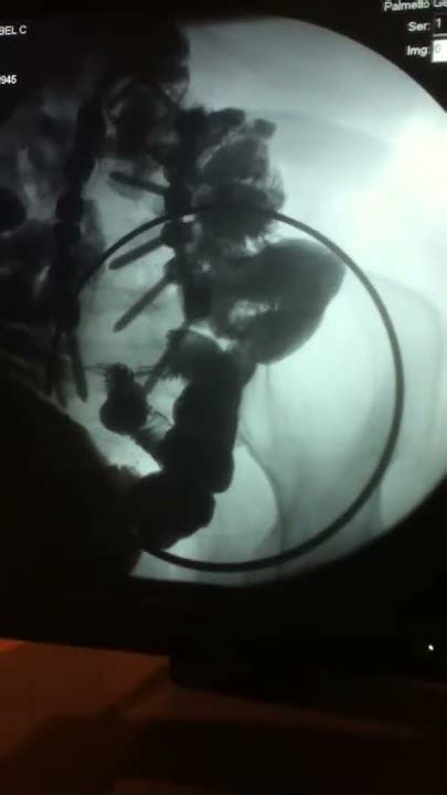 Random Flouroscopy Study Youtube