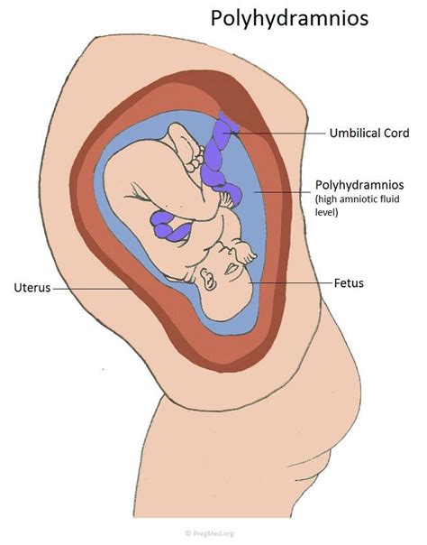 Polyhydramnios High Amniotic Fluid Pictures Fetal Abnormalities