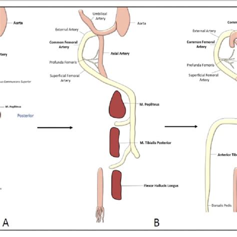 Variation Of Branching Pattern Of The Popliteal Artery Type I Normal