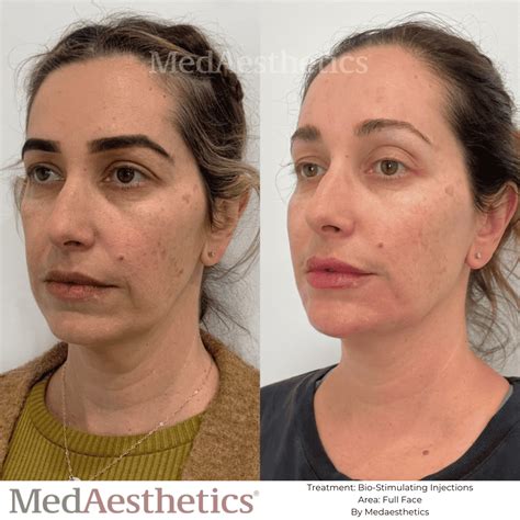 List 92 Pictures Collagen Injections Before And After Photos Superb