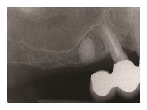 Three Implants 14 15 And 16 Inserted With The Lateral Window