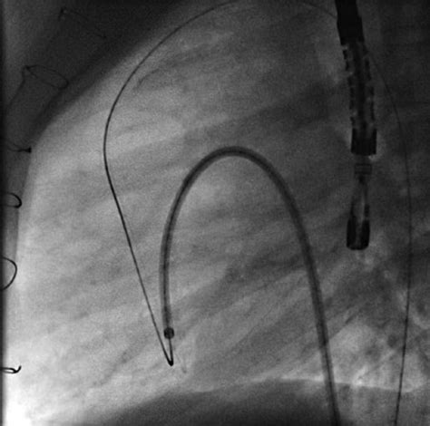 Muscular Amplatzer Vsd Occluder Device Implanted At Subvalvular