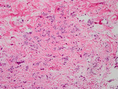 Pseudoxanthoma Elasticum Histology