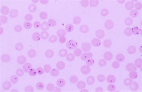 El RincÓn De La Medicina Interna Frotis De Sangre Periférica En Paciente Con Malaria