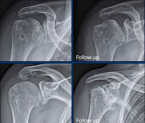 X Ray Shoulder Arthritis Uw Shoulder And Elbow Academy Rheumatoid