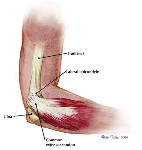 Extensor Tendonitis Elbow Tendinopathy Why Do Tennis Elbow