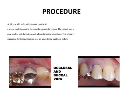 Socket Shield Technique Pptx