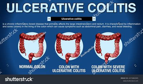 Ulcerative Colitis Symptoms Infographic Illustration Stock Vector