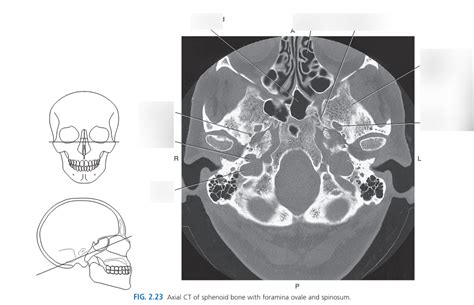 Axial Ct Of Sphenoid Bone With Foramina Ovale And Spinosum Diagram