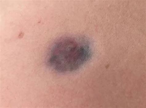 Dermatofibrossarcoma Protuberans