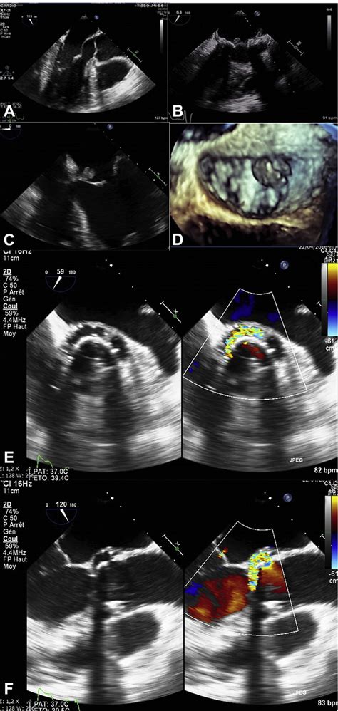 Echocardiographic Findings In Mitral Valve Endocarditis A Normal Download Scientific Diagram