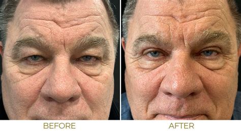 Hooded Eyes Men Before And After