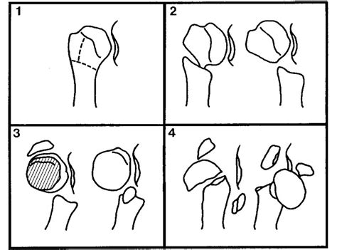 The Neer Classification Of Fractures Of The Surgical Neck Of