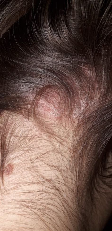 Dovobet For Scalp Psoriasis Rpsoriasis