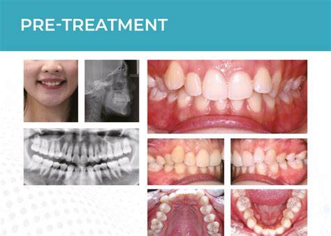 Crowding Deepbite Midline Discrepancy Trioclear™