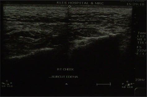 Ultrasonographic Image Showing Cellulitis Of Buccal And Canine Spaces
