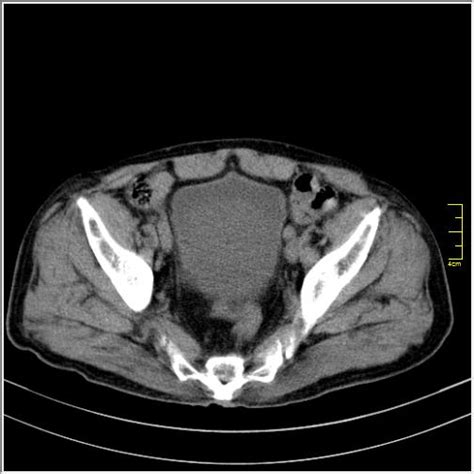 Radiopaedia Case Urinary Bladder Hematoma Id 59790 Study 67220 Nc