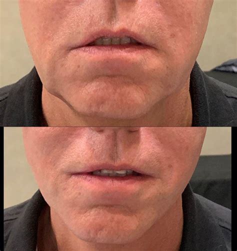 Pdo Threads Expertise Lumier Medical