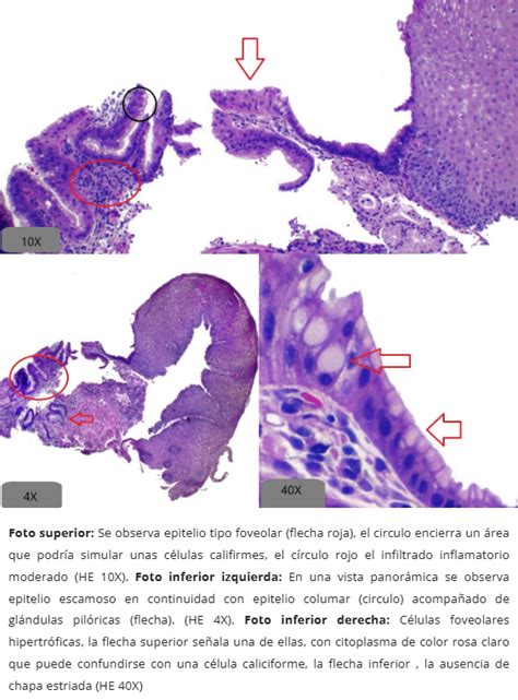 Metaplasia Columnar Sin Caliciformes Histodiagnostico