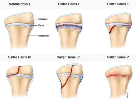 Extremity Injuries Clinical Tree