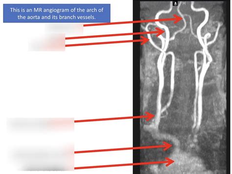 Diagram Of Mri Angiogram Of Arch Of Aorta Quizlet