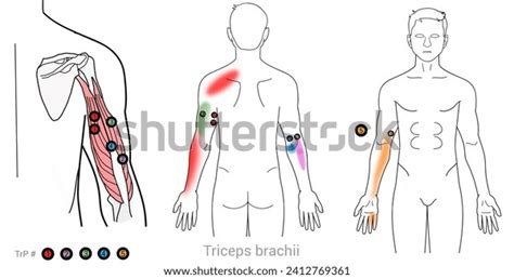 Myofascial Trigger Point Triceps Brachii Stock Illustration 2412769361 Shutterstock