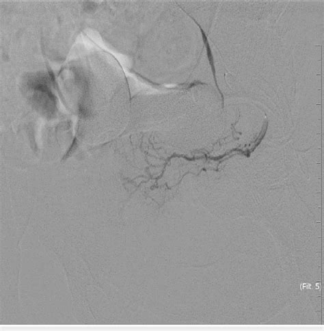 Selective Angiogram Of The Left Prostatic Artery Showing Normal Download Scientific Diagram