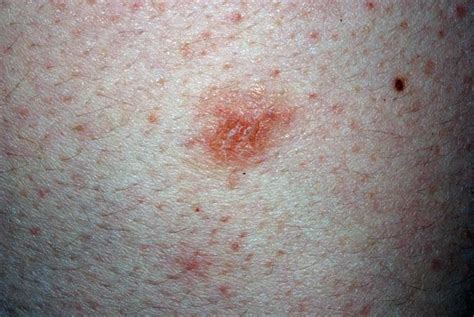 Eczema Numular Drug Induced Nummular Dermatitis Hoogstra Medical