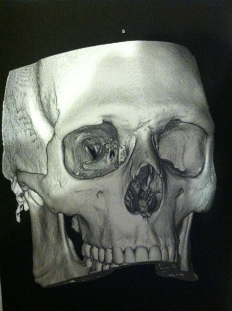 After My Third Amateur Mma Fight The Commission Made Me Get A Ct Scan