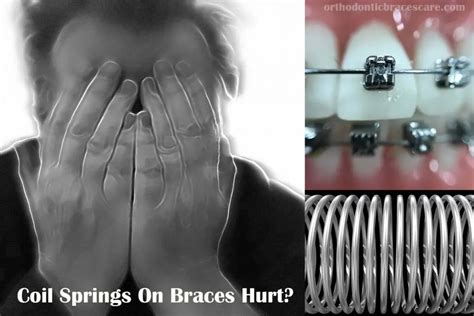 Coil Springs Braces Hurt How Long Causes Pain Relief Tips